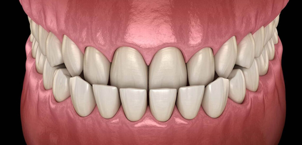 Wilmette orthodontist & Braces Specialist Explains Underbites