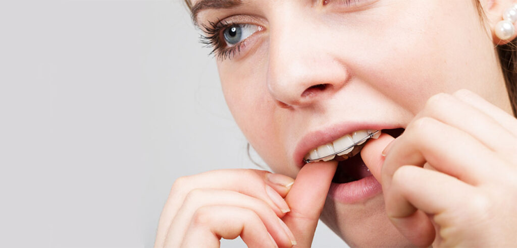 Teeth On the Move: All About Relapse & Retainers - Stosich Consulting