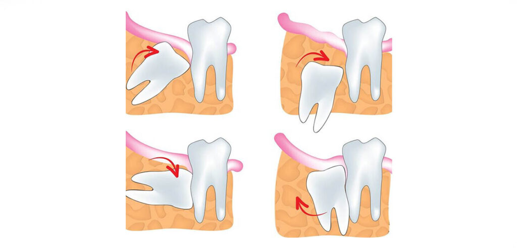 Do Wisdom Teeth Make Other Teeth Crooked?