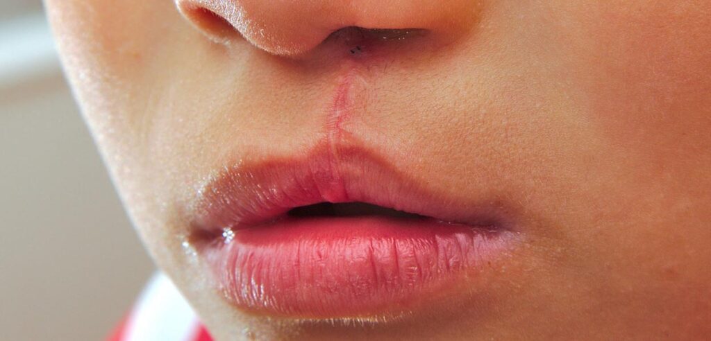 NAM, an Important Step in Cleft Palate Treatment