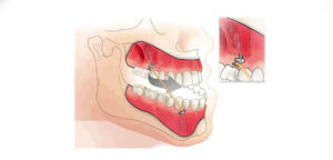 What Are Bollard Miniplates?