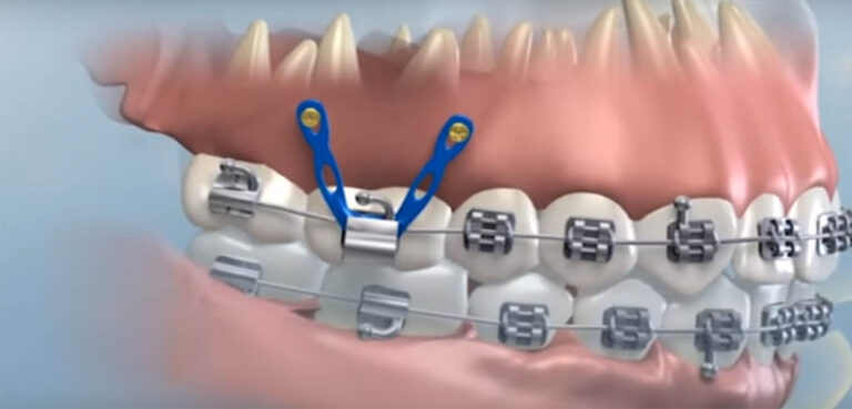 What is the Role of Temporary Anchorage Devices (TADs) in Orthodontics