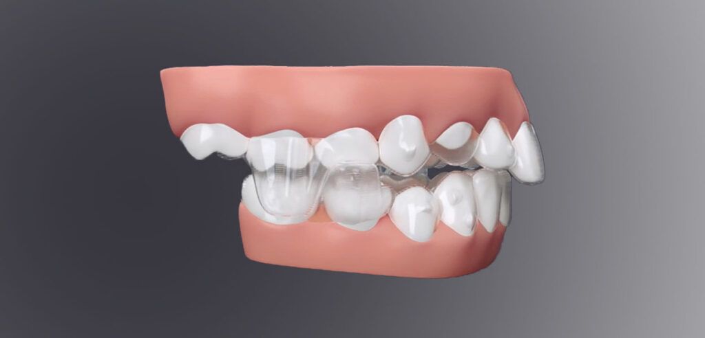 Explaining the Purpose of Mandibular Advancement to Correct Smiles