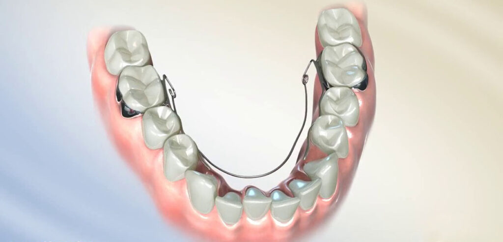 Lower Lingual Holding Arch Appliance Explained - Stosich Consulting