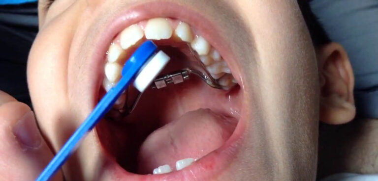 What Is A Palatal Expander And How Does It Work?