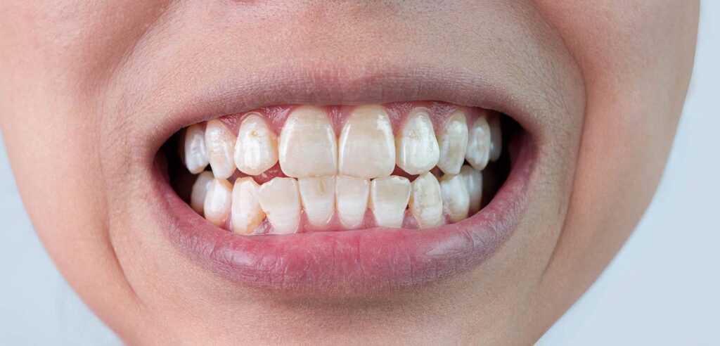 How to Avoid White Spots After Braces - Round Lake Orthodontist Answers