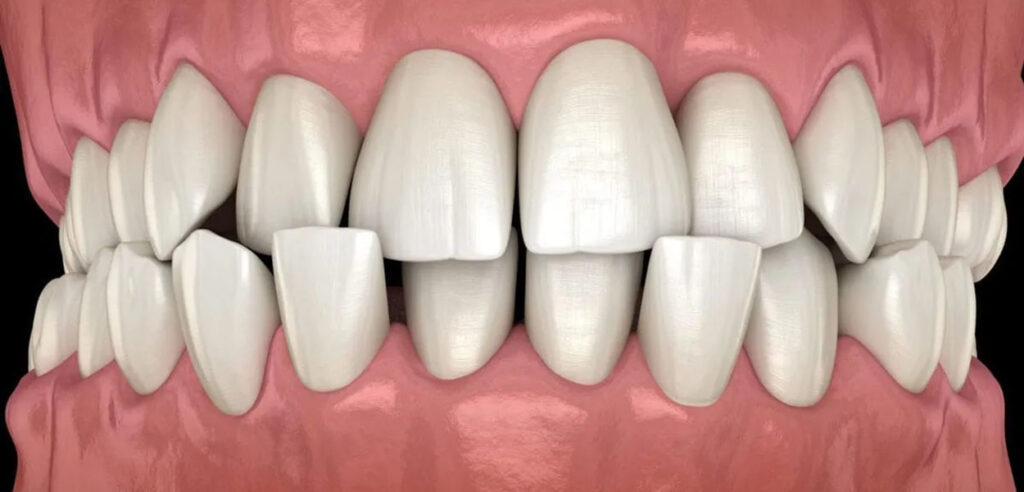 What is a Crossbite and How Can it Be Corrected?