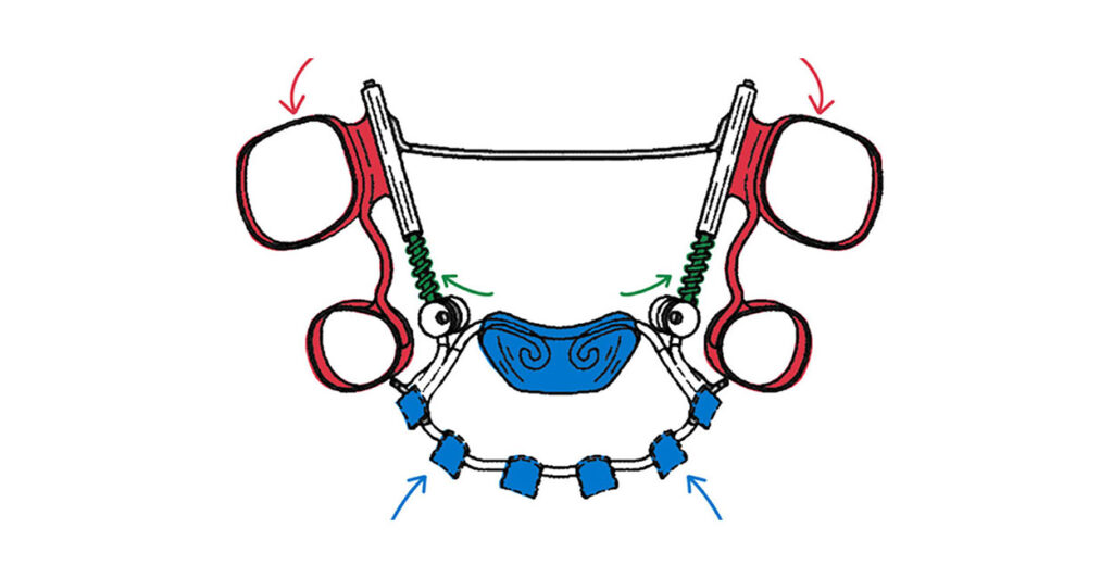 Anterior Growth Guidance Appliance (AGGA) - Separating Fact From Fiction